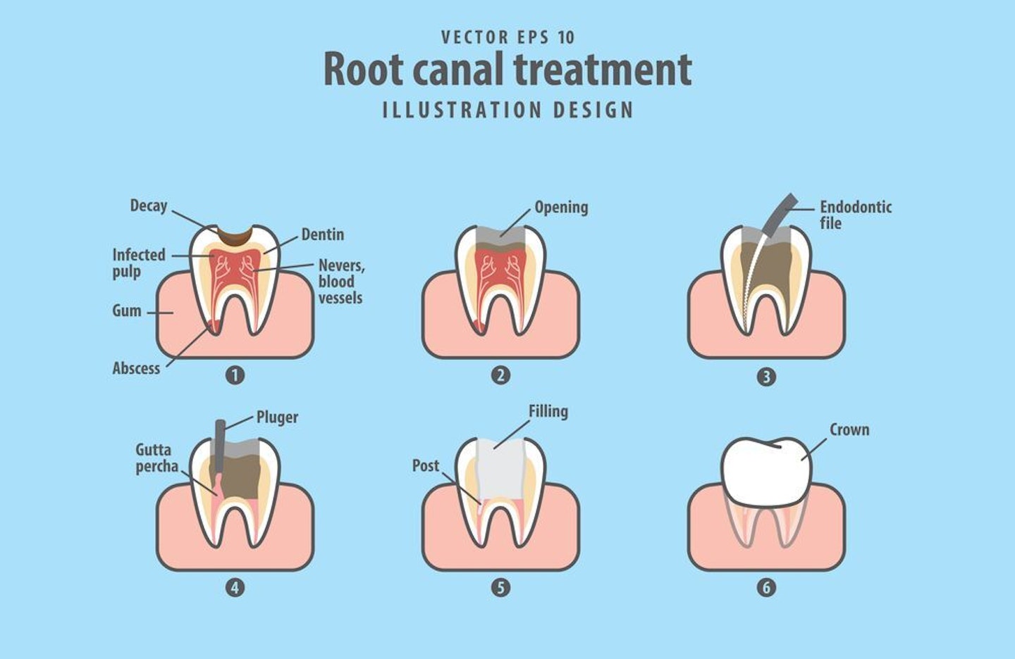 Root Canal or Extraction: Which Choice is Best? | Cedar Spring Dentistry