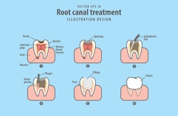 Root Canal Or Extraction Which Choice Is Best Cedar Spring Dentistry